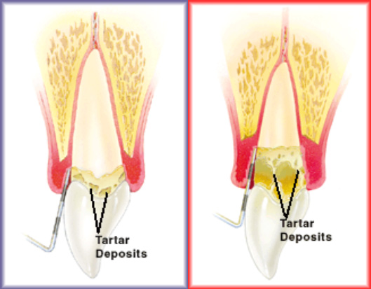 Pocket Reduction Procedures – Eastside Periodontic and Implantology